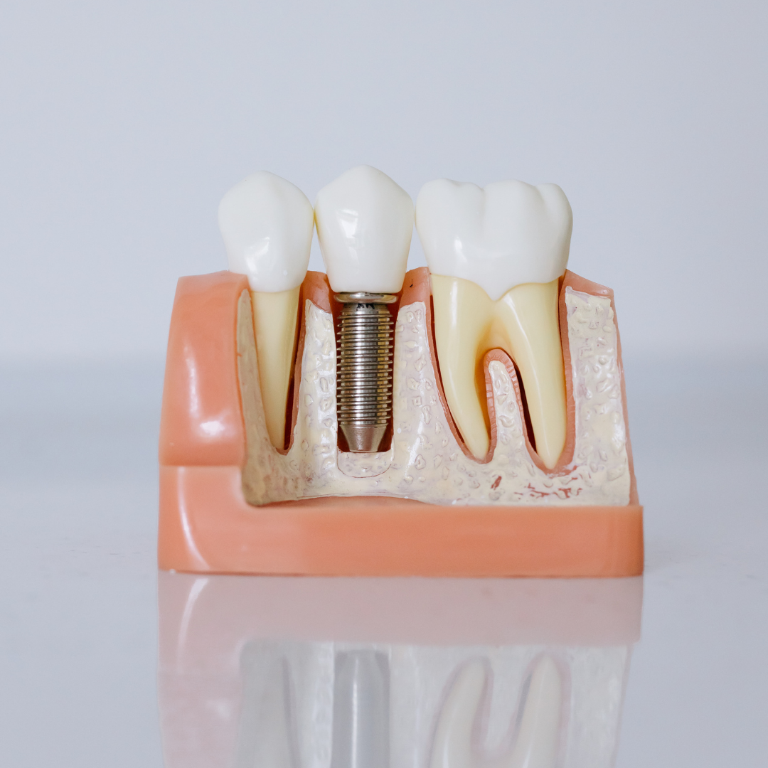 Diş İmplantları - DentClub